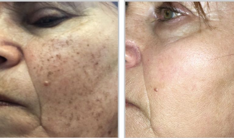 What Causes Dark Patches on Skin? - No.23 Skin