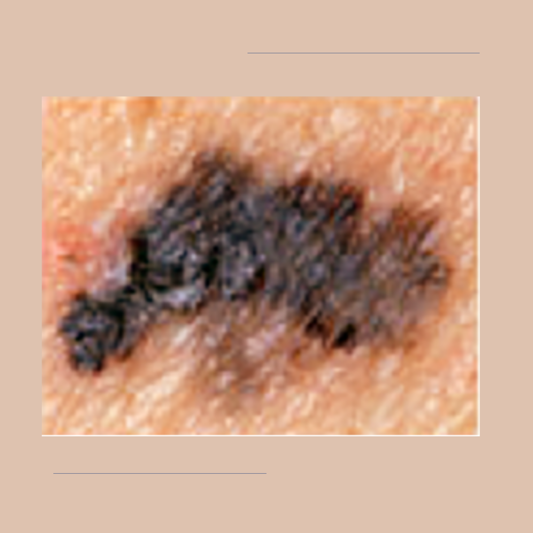 Moles: 5 Things to Check - No.23 Skin